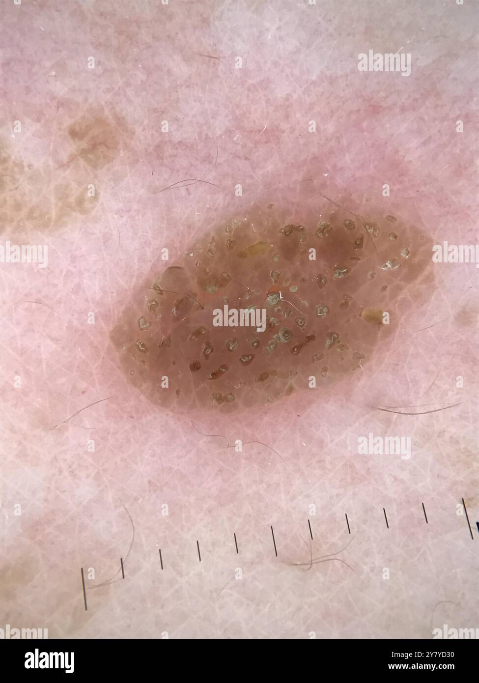 Dermatoscope image of a seborrheic keratosis with comedo-like openings ...