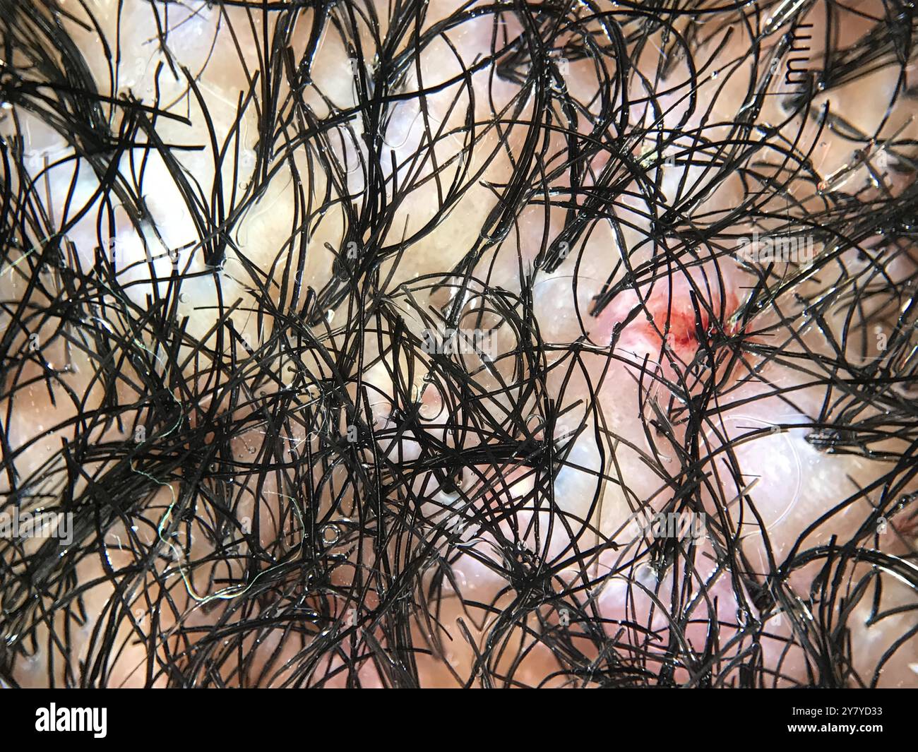 Trichoscope image of tufted folliculitis on the head of a 24 year old ...