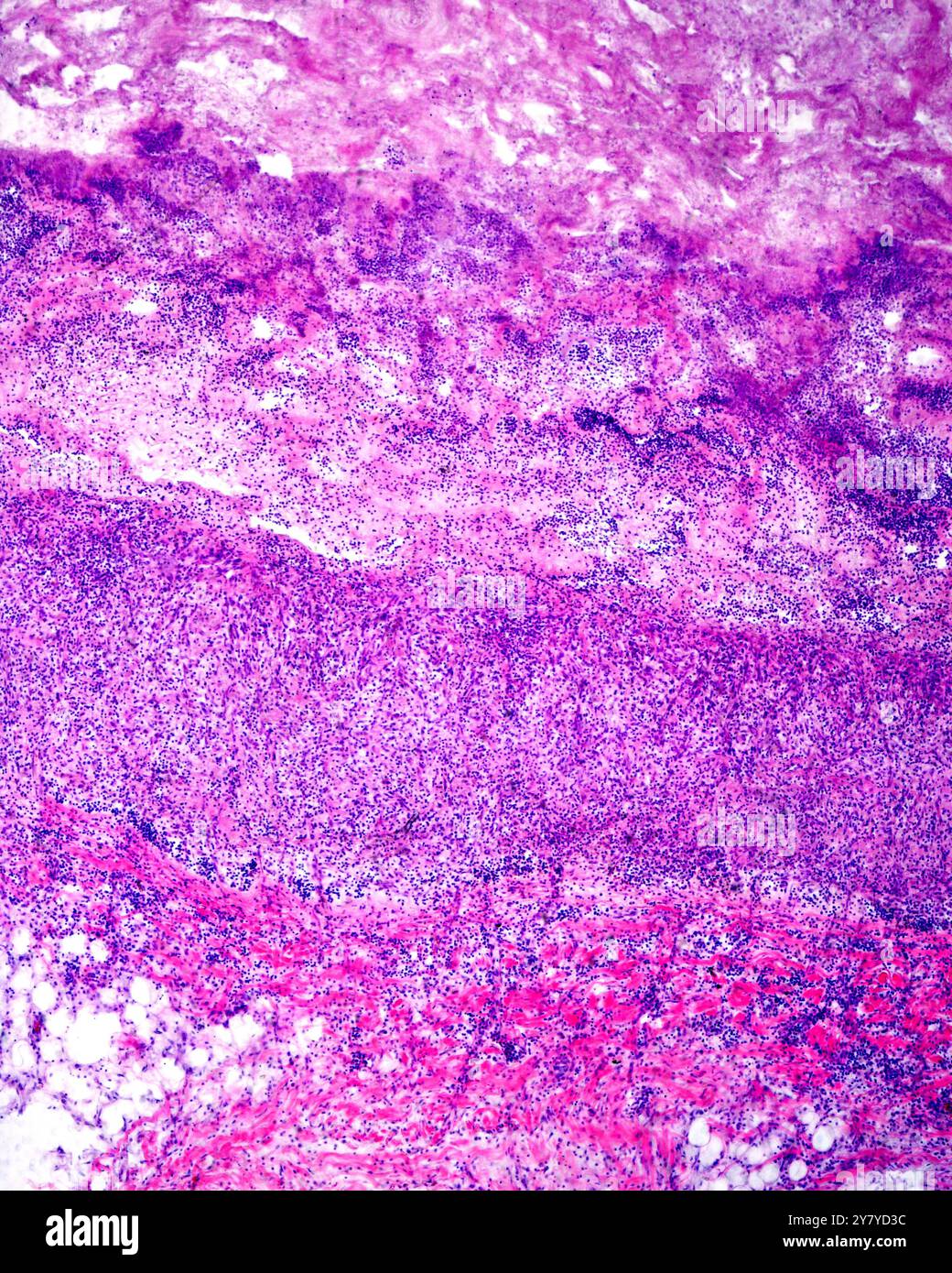 Human heart. Light micrograph showing a severe chronic endocarditis ...