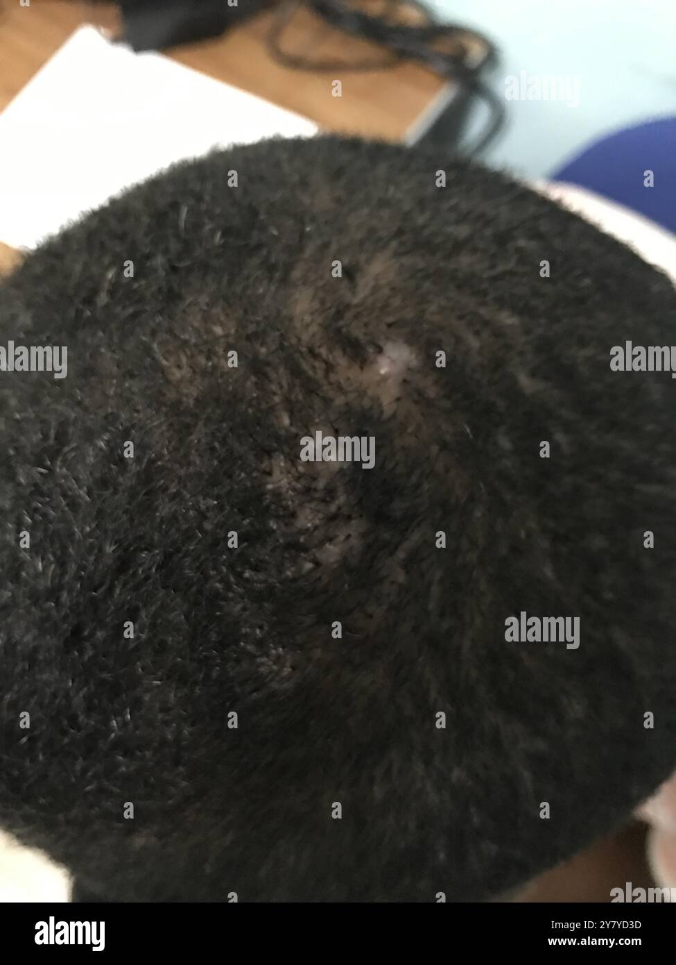 Tufted folliculitis on the head of a 24 year old African-American male ...