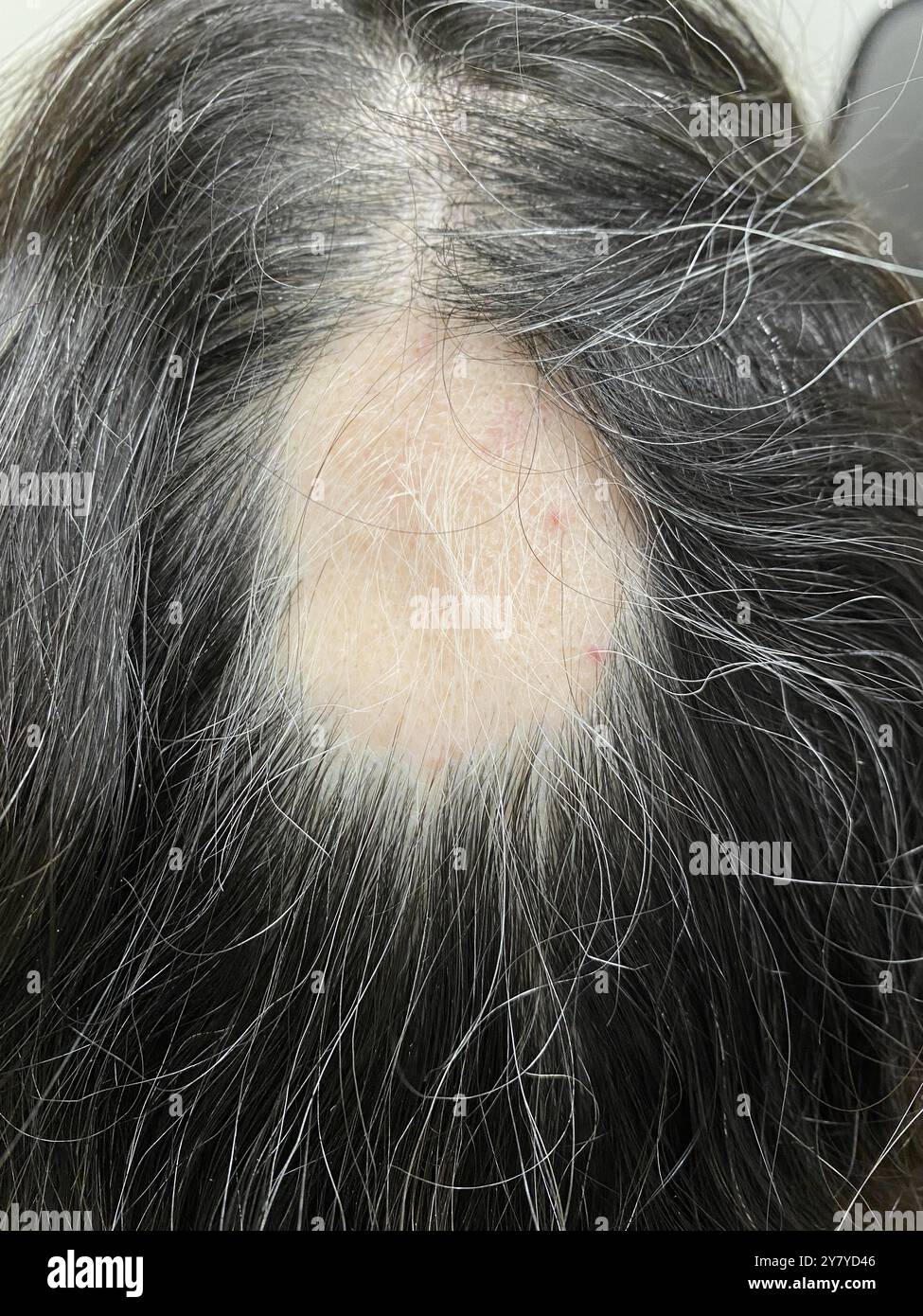 Hair regrowth on a bald spot on the scalp of a patient with alopecia ...