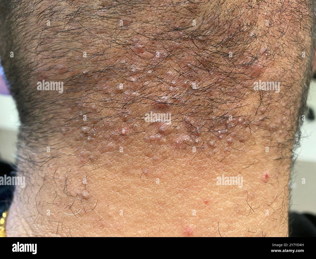 Acne keloidalis nuchae (AKN) on the nape of a patient's neck. AKN is a ...