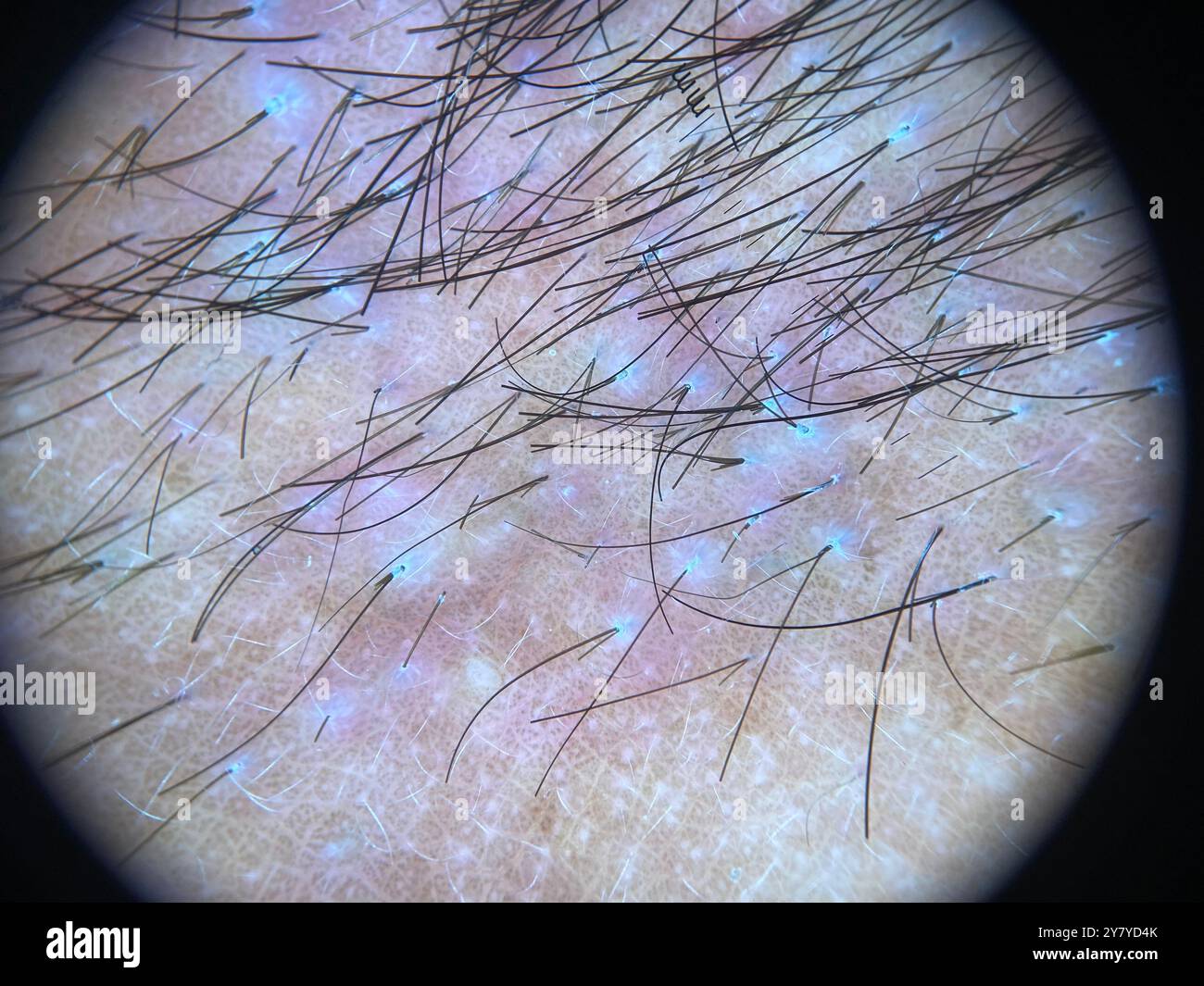 Dermatoscope image of acne keloidalis nuchae (AKN). AKN is a type of ...