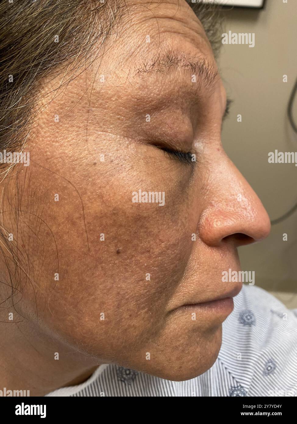 Ashy dermatosis on the face of a Hispanic female patient. This ...