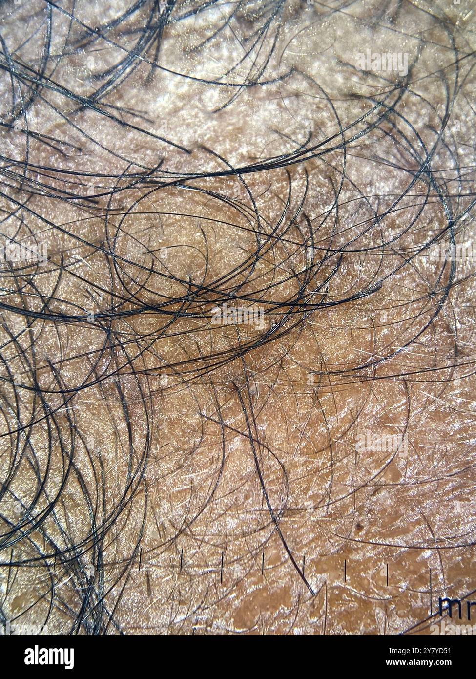 Dermatoscope image of the scalp of an Africa-American female patient ...