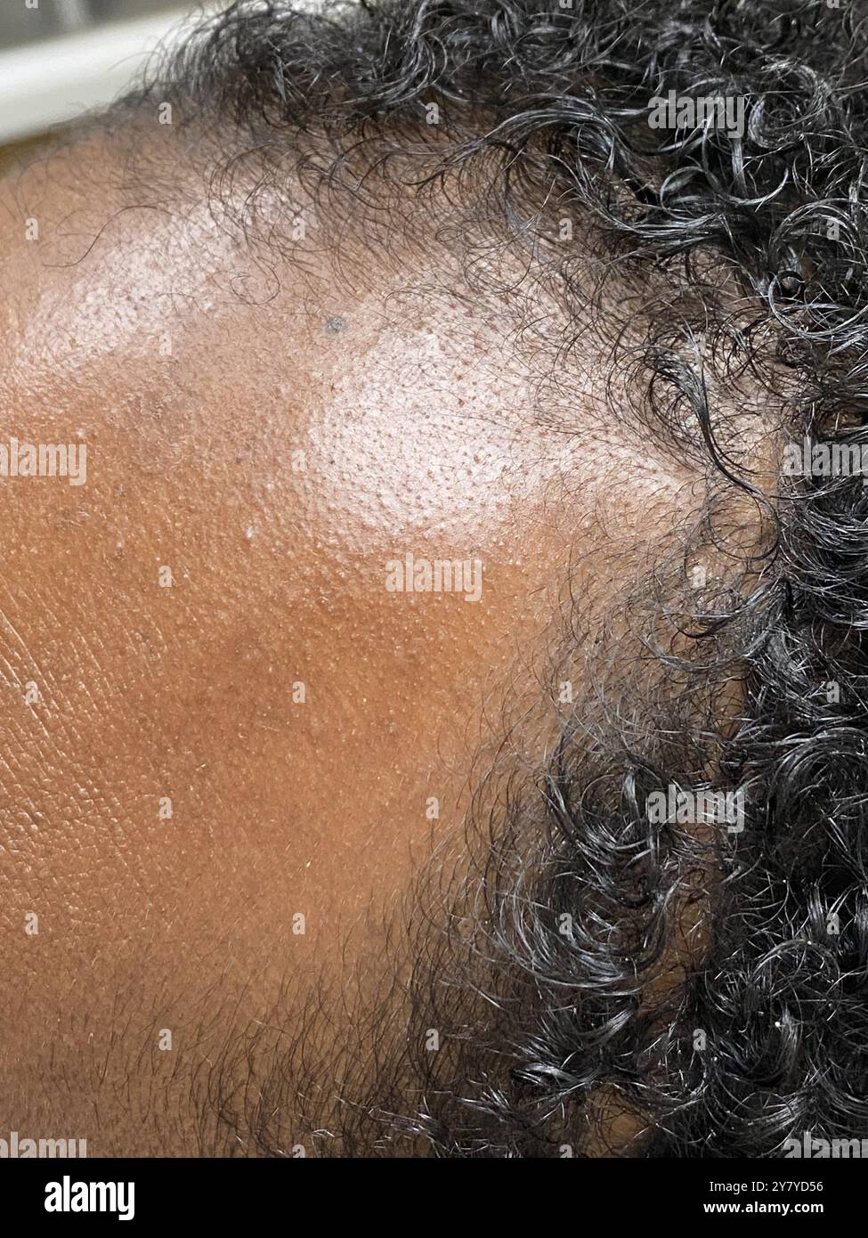 Hairline of an Africa-American female patient with female pattern hair ...