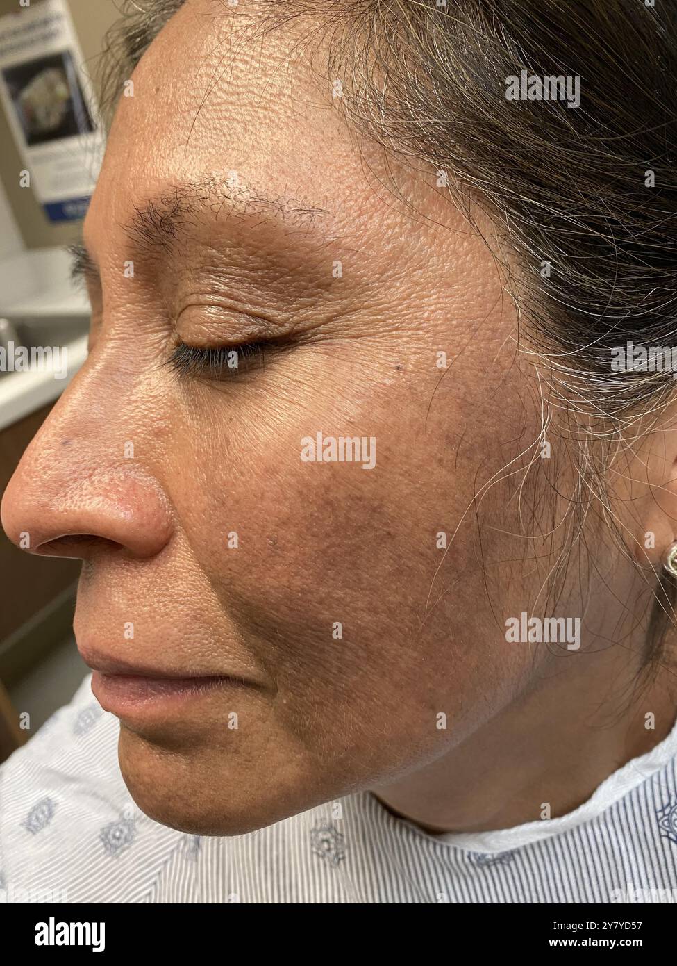 Ashy dermatosis on the face of a Hispanic female patient. This ...