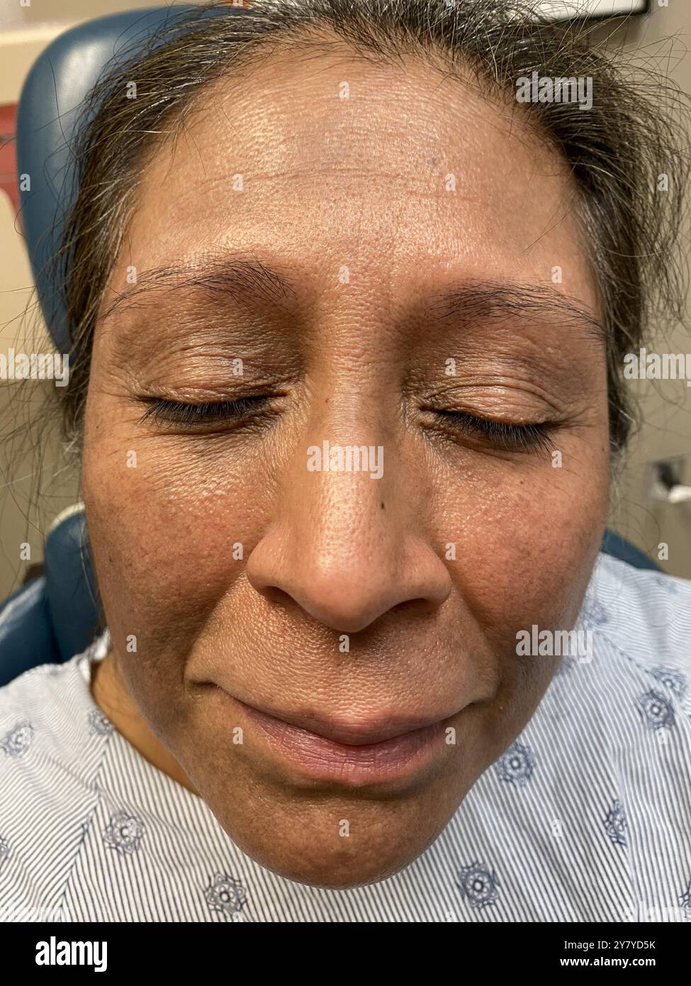 Ashy dermatosis on the face of a Hispanic female patient. This ...