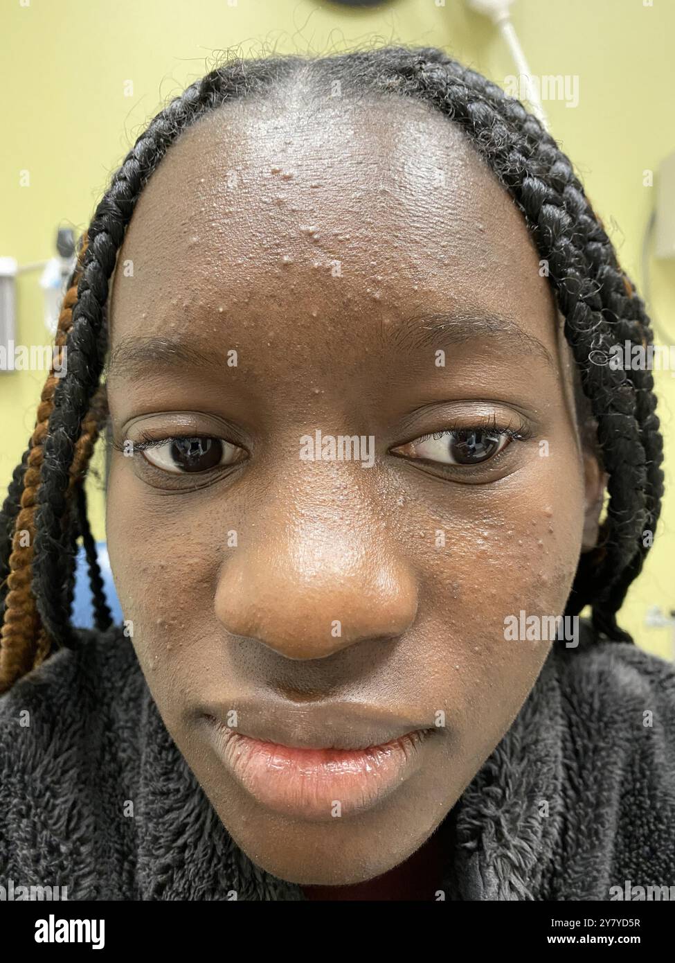 Acne on the face of an African American female patient. Acne is a ...