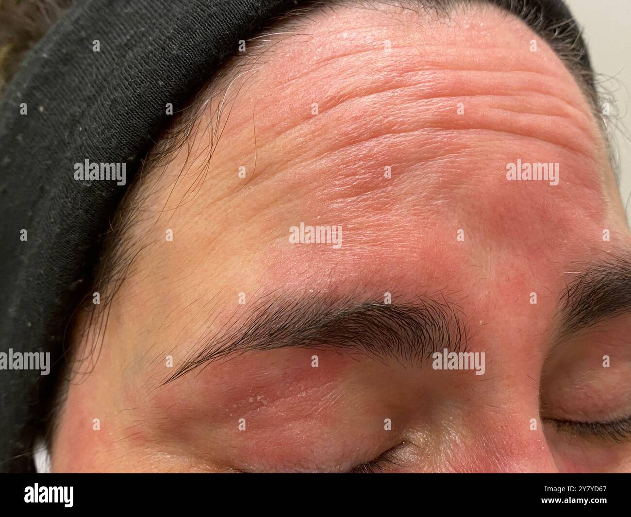 Redness on the face of a patient with cutaneous lupus erythematosus (LE ...