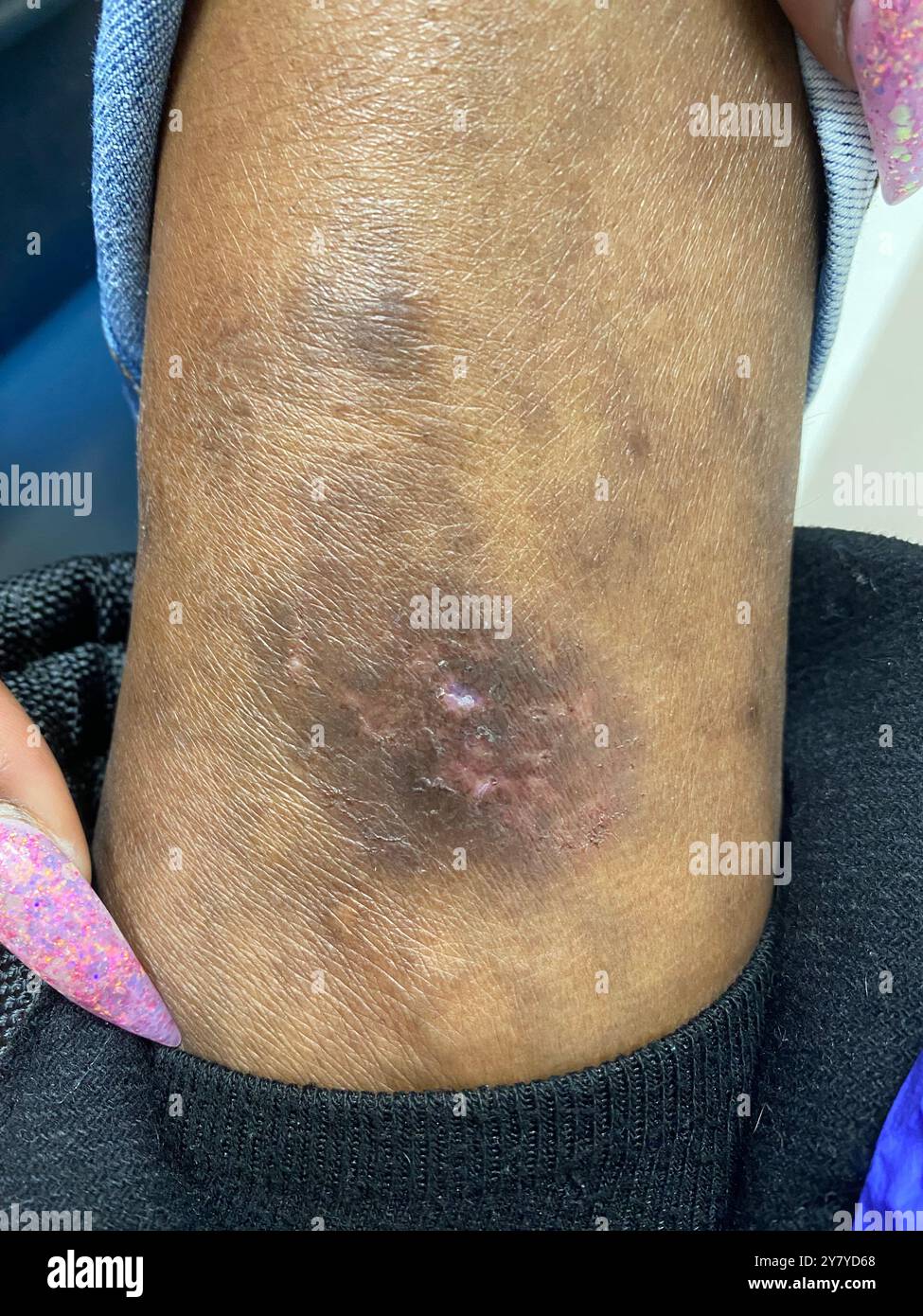 Lesions on the lef of a 34 year old Black female patient with discoid ...