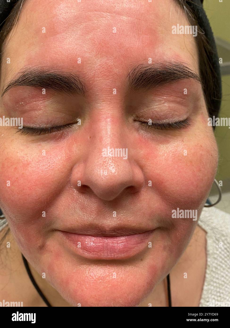 Redness on the face of a patient with cutaneous lupus erythematosus (LE ...