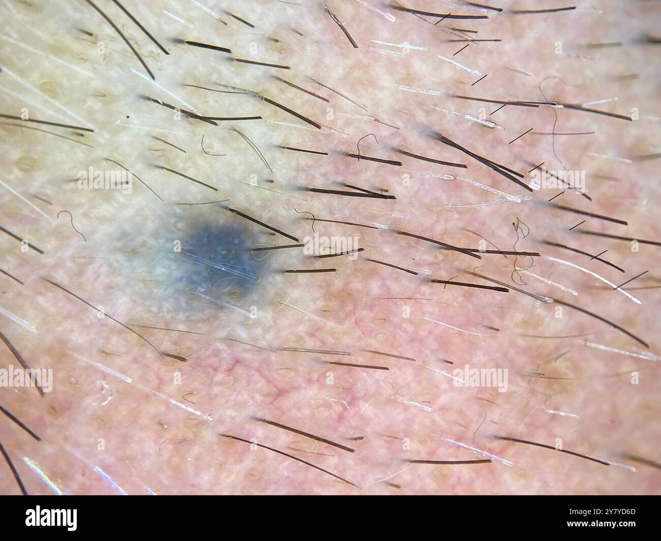 Dermatoscope image of a blue naevus on a patient's skin. This is a ...