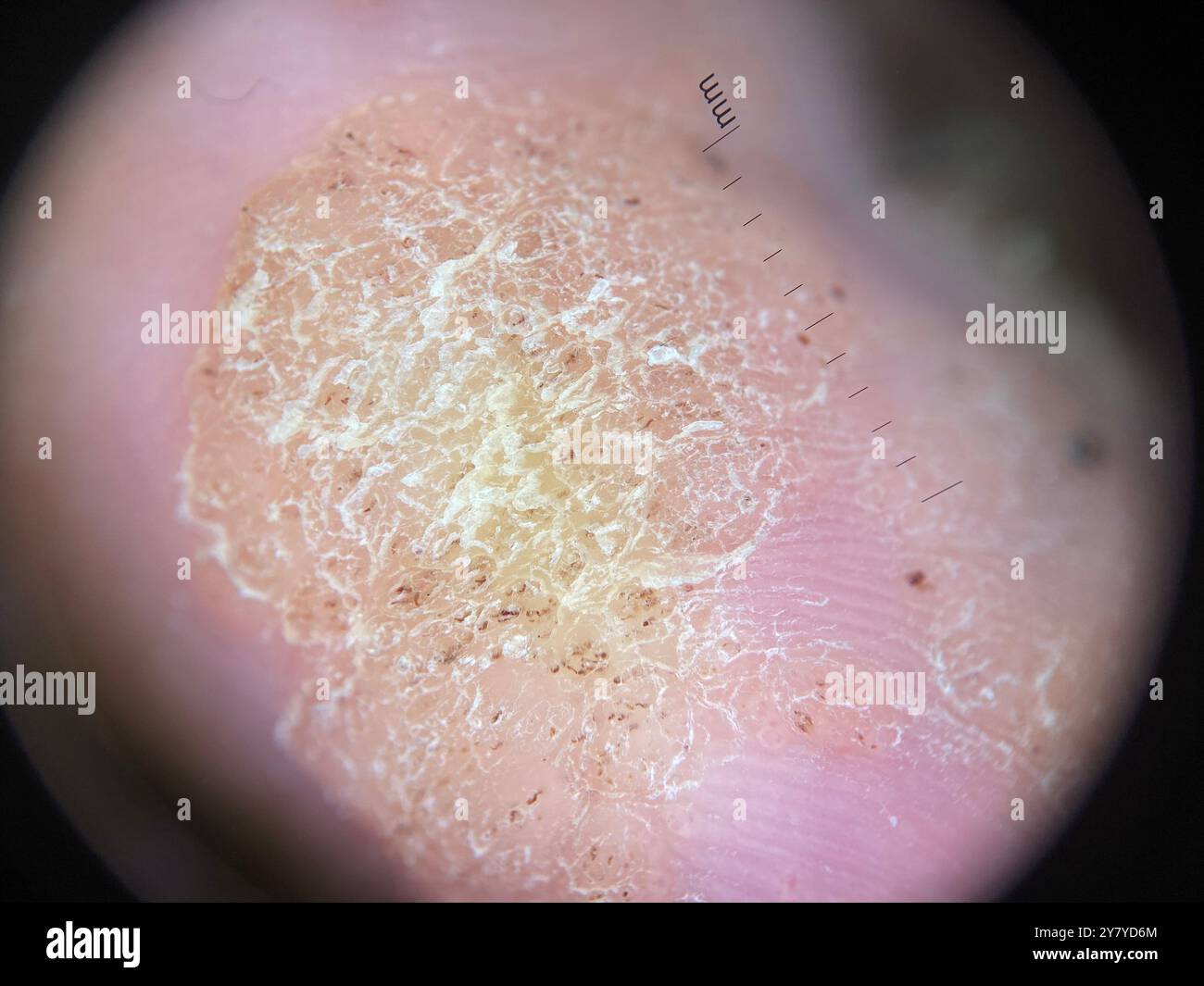 Dermatoscope image of a wart on a patient's finger. Warts are caused by ...