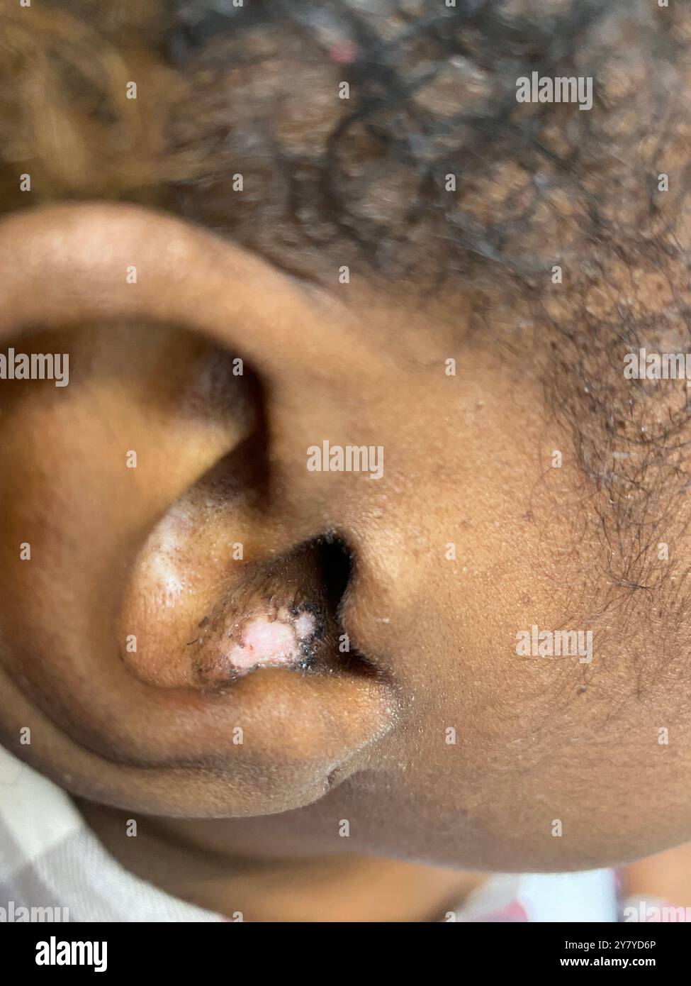Lesion in the ear of a 34 year old Black female patient with discoid ...