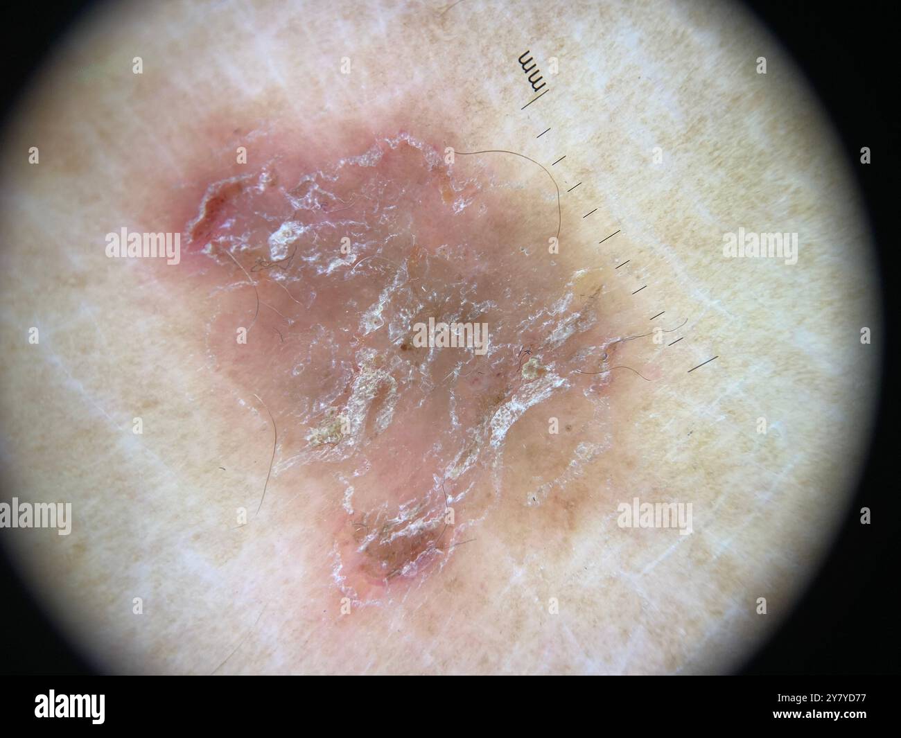Dermatoscope image of pityriasis lichenoides chronica lesions on the ...