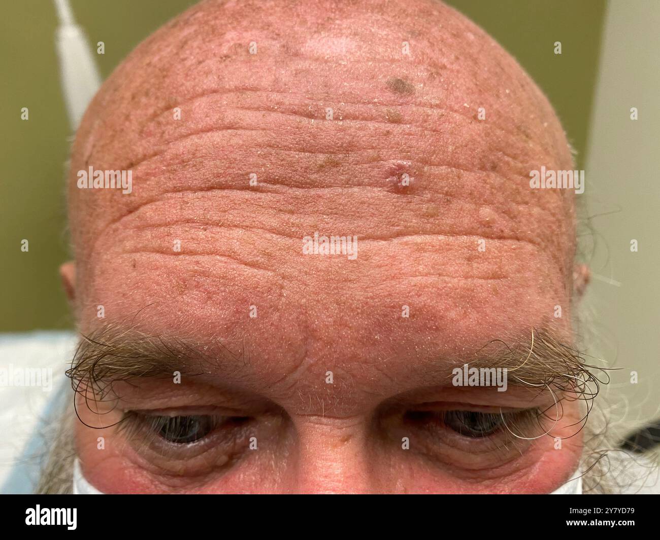 Nodular basal cell carcinoma (BCC), or rodent ulcer, on a the forehead ...