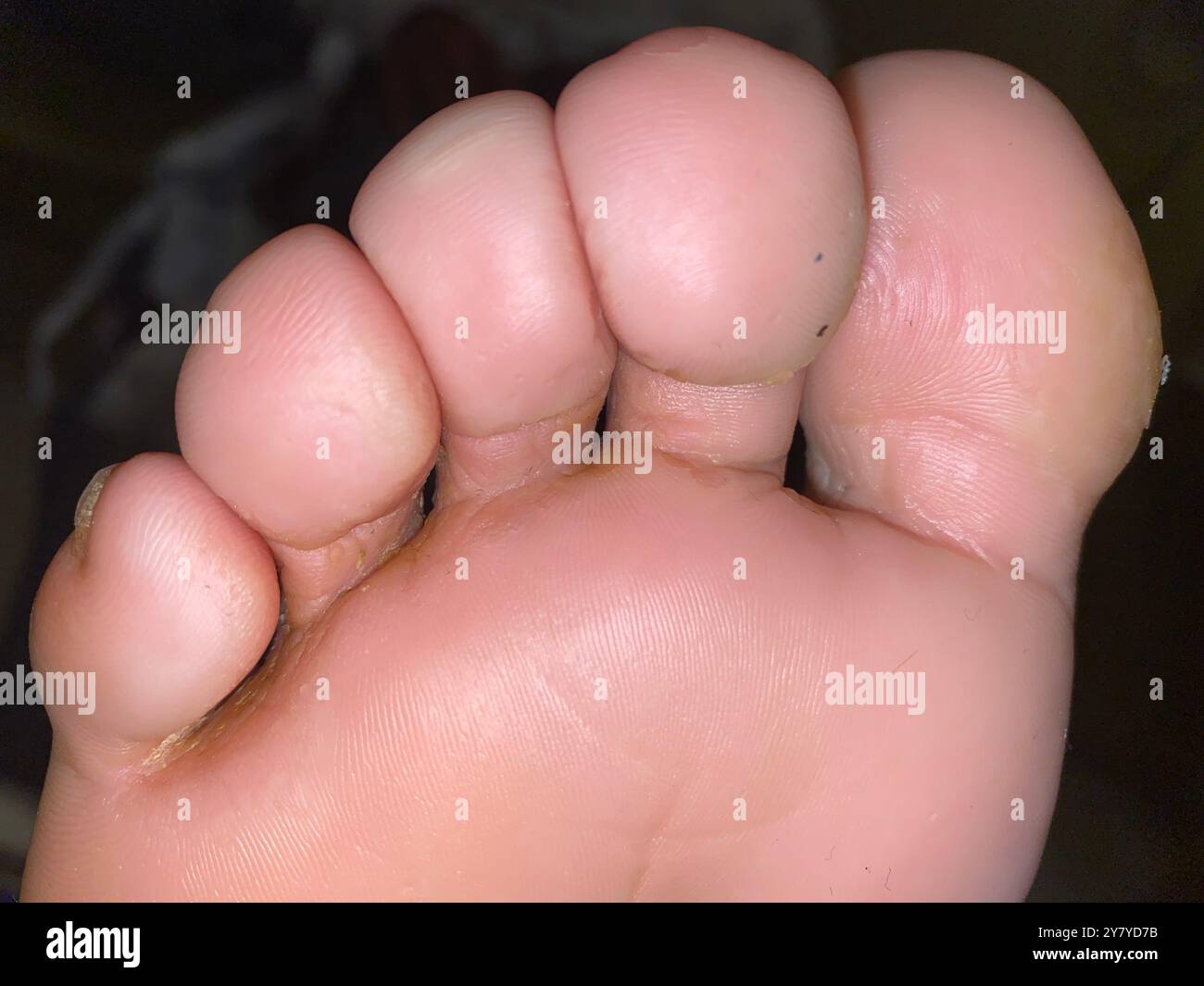 Underside of the toes of a patient with pitted keratolysis. This is a ...