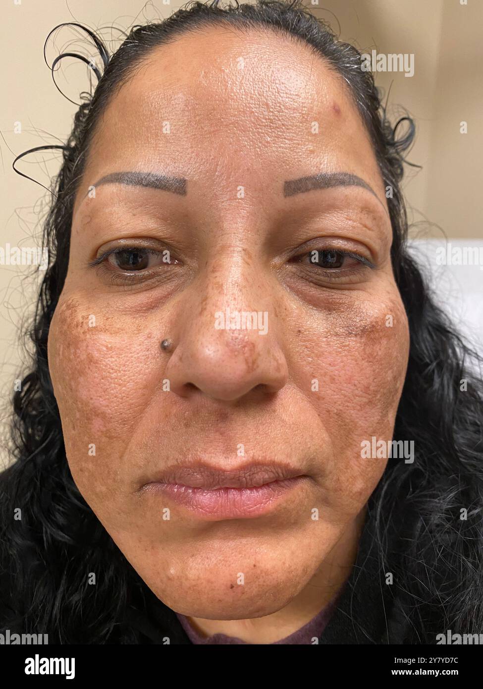 Editorial use only Melasma on a woman's face. Melasma, or chloasma, is ...