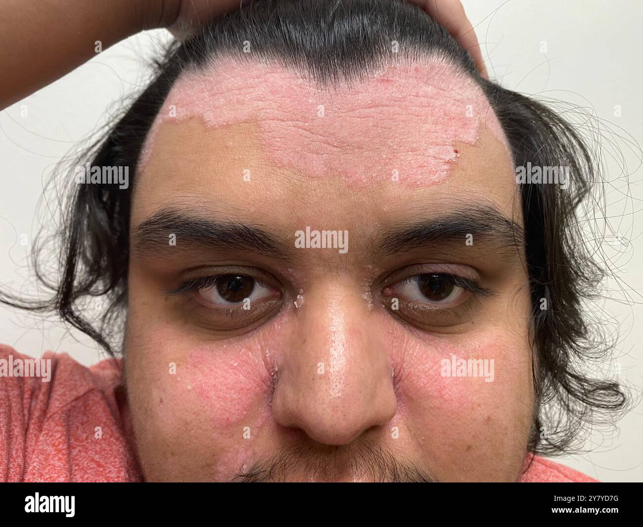 Psoriasis on the face of a Hispanic male patient. Psoriasis is a skin ...