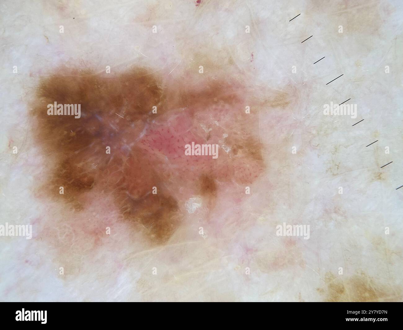 Dermatoscope image of a melanoma on the right shoulder of a 70 year old ...