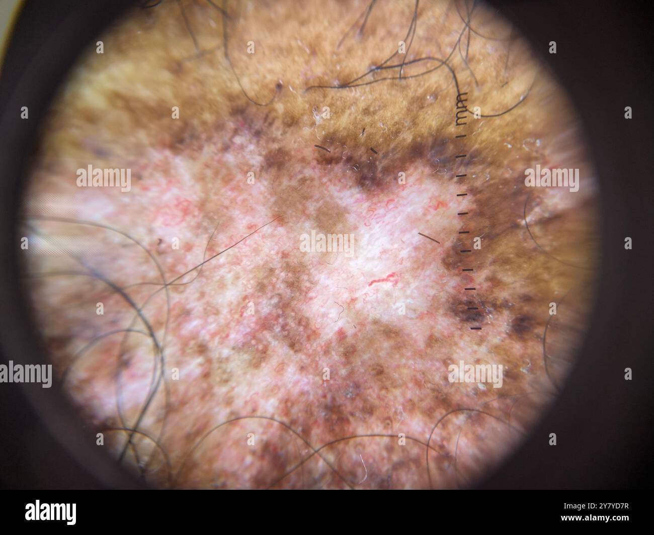 Dermatoscope image of lesions on the skin of a 34 year old Black female ...