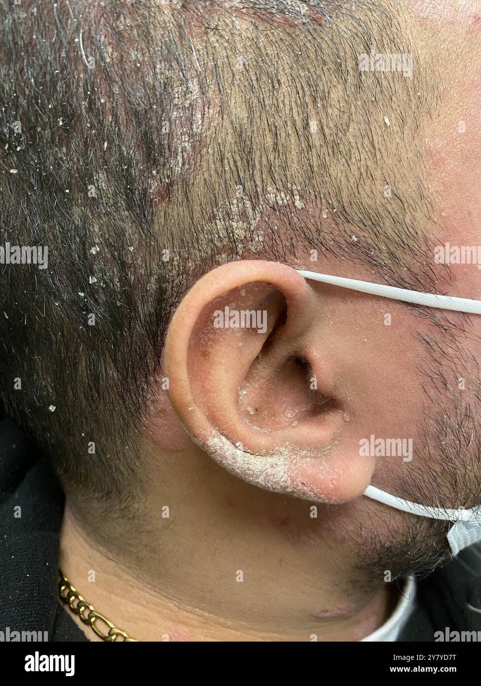 Psoriasis on a patient's ear and scalp. Psoriasis is a skin condition ...