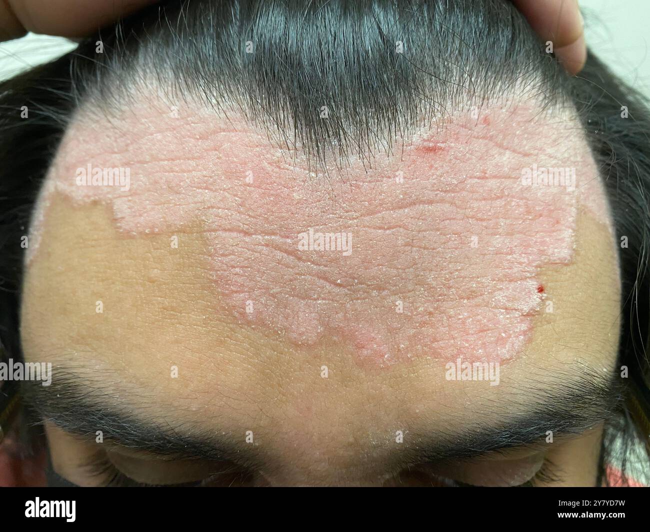 Psoriasis on the forehead of a Hispanic male patient. Psoriasis is a ...