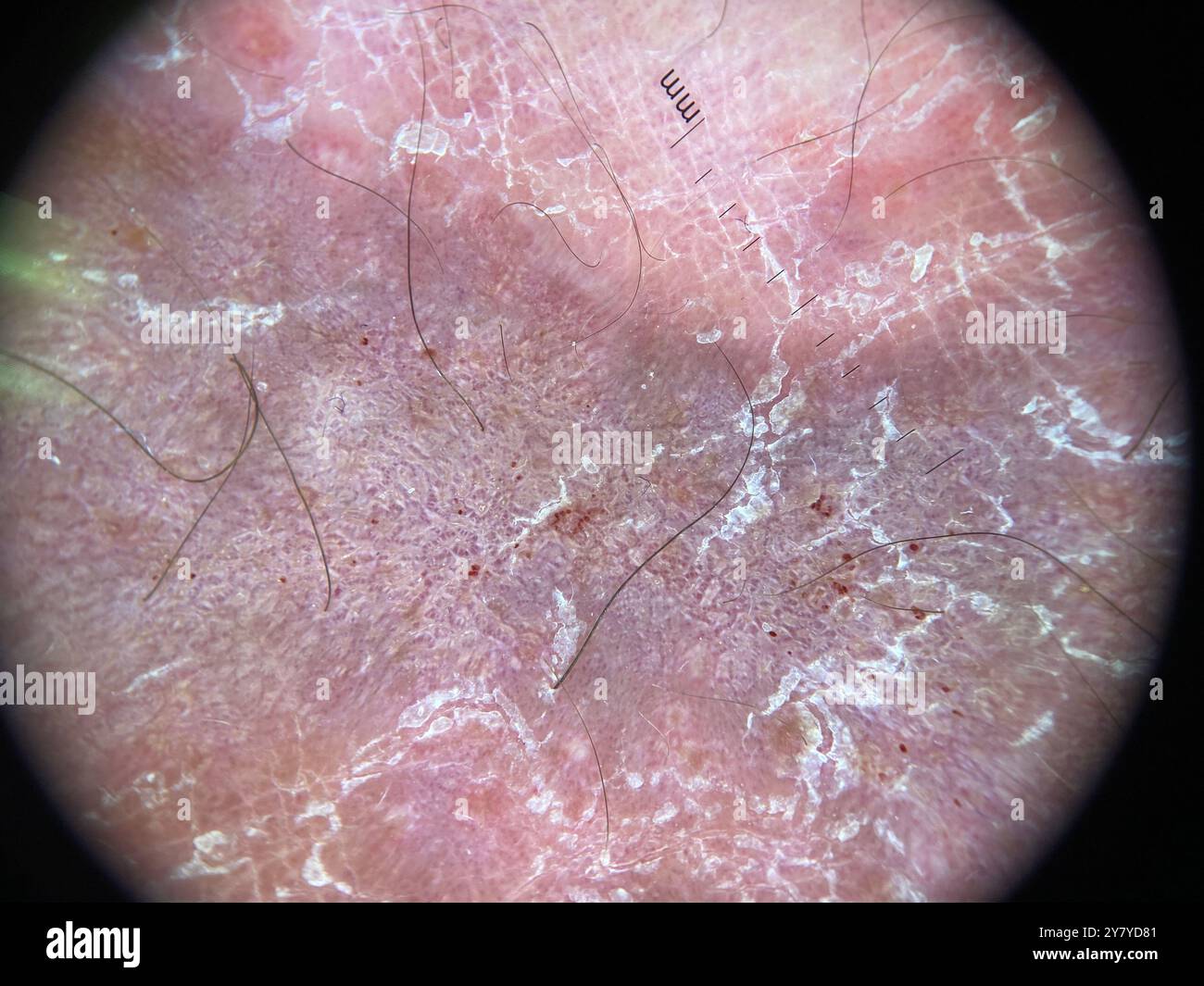 Dermatoscope image of psoriasis on the leg of a Hispanic female patient ...