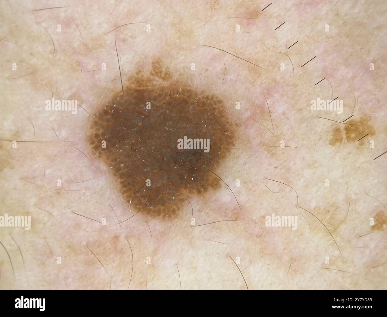 Dermatoscope image of a seborrheic keratosis on a patient's skin. This ...