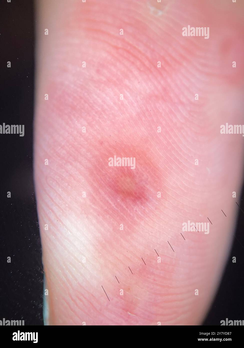 Dermatoscope image of the finger of a 21 year old Hispanic female ...