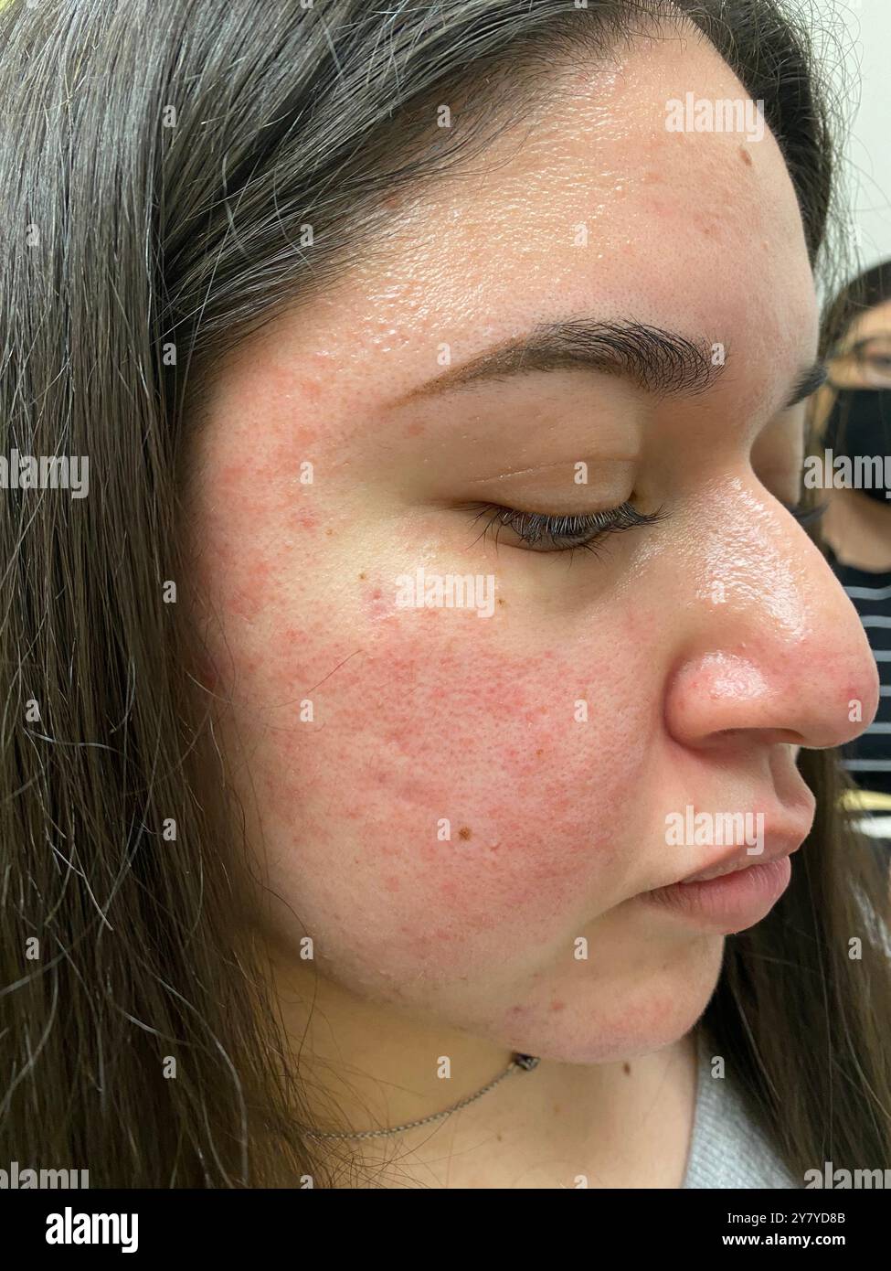 Redness on the face of a patient with systemic lupus erythematosus (SLE ...