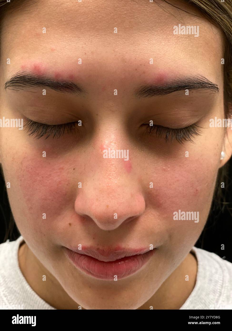 Redness on the face of a 21 year old Hispanic female patient with ...