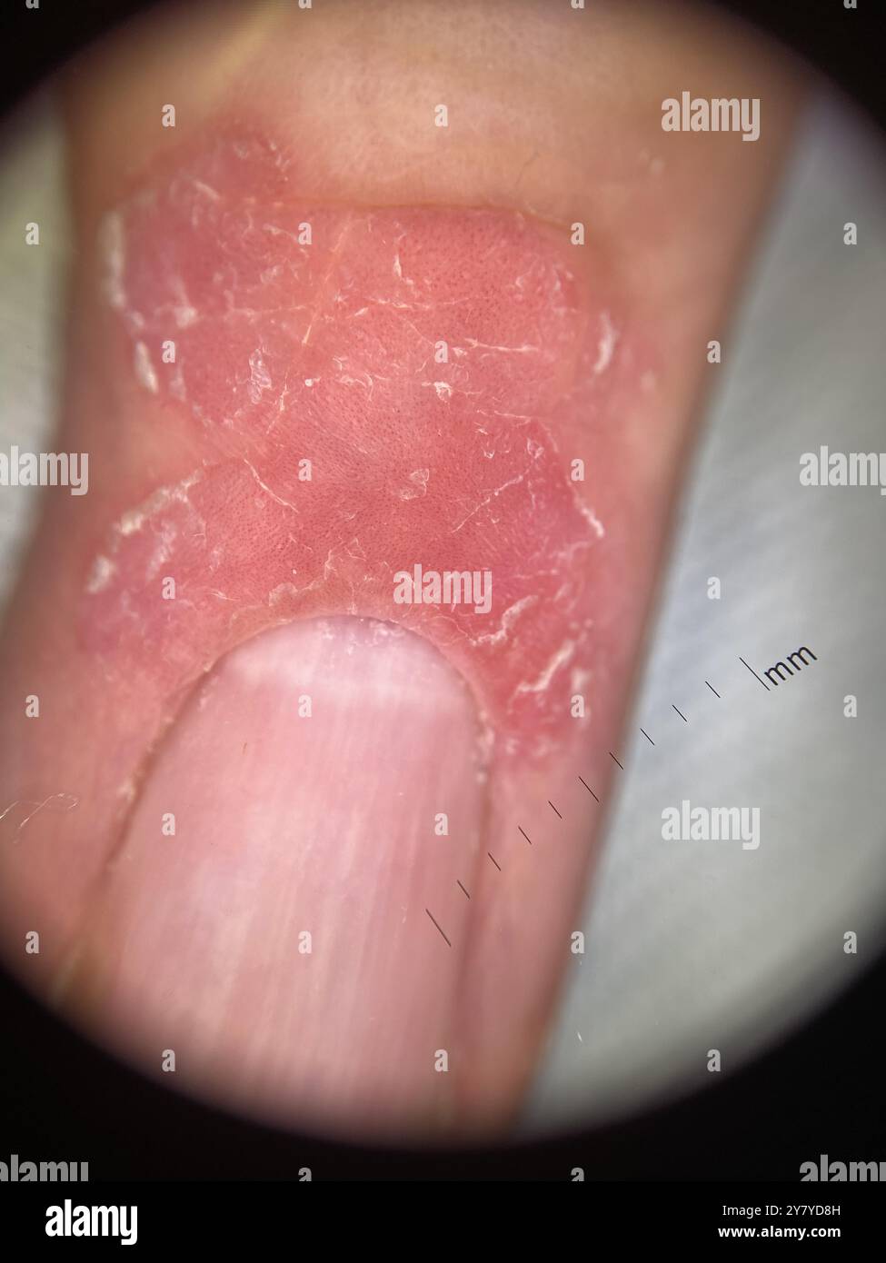 Dermatoscope image of psoriasis on a patient's finger. Psoriasis is a ...