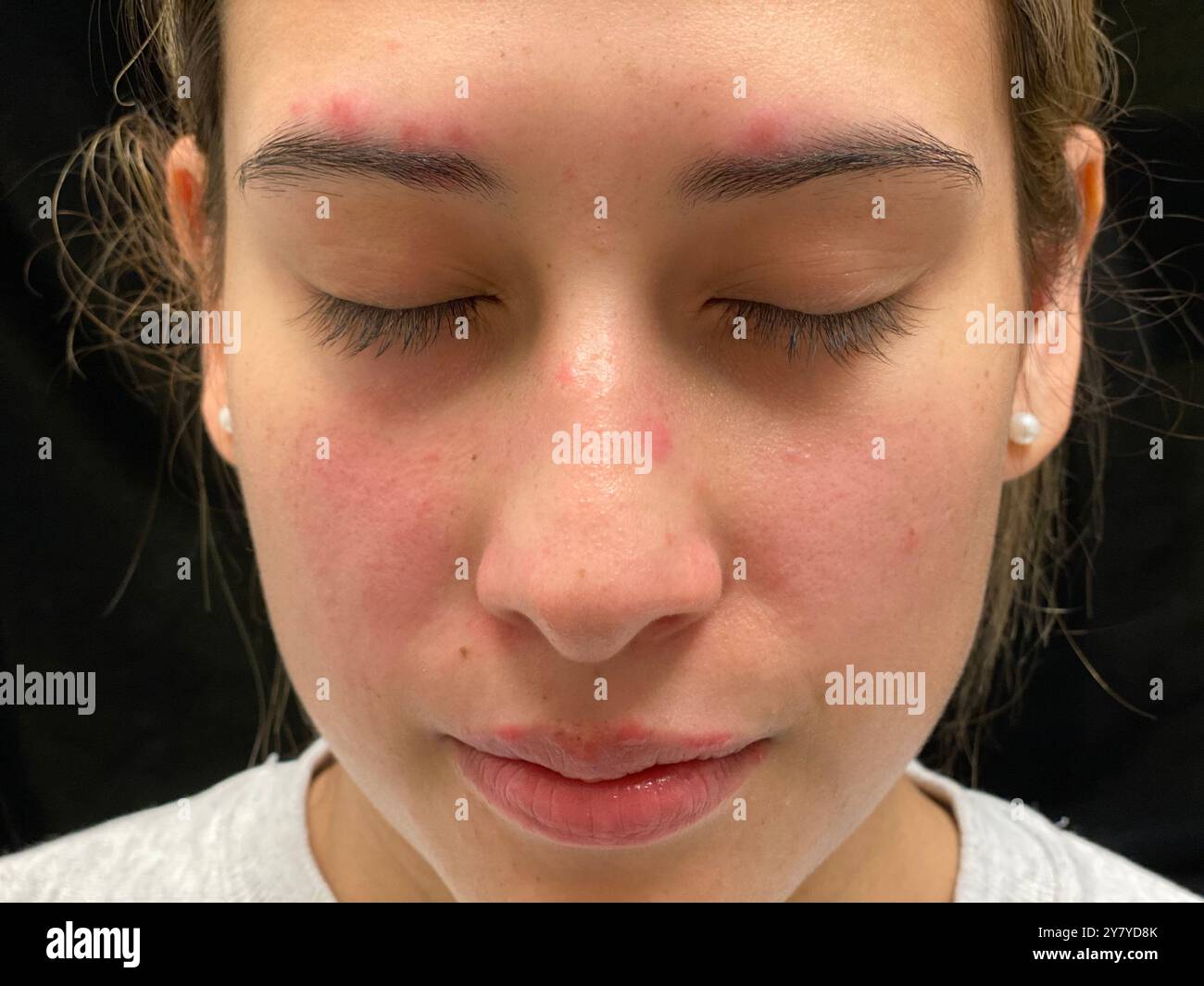 Redness on the face of a 21 year old Hispanic female patient with ...