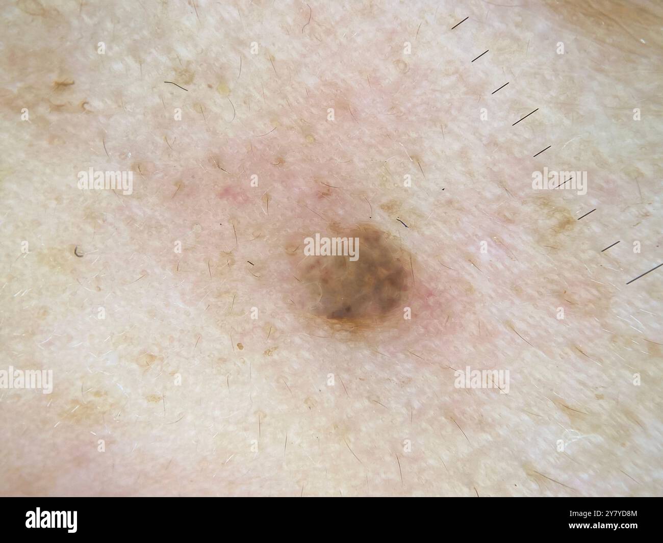Dermatoscope image of a seborrheic keratosis on a patient's skin. This ...