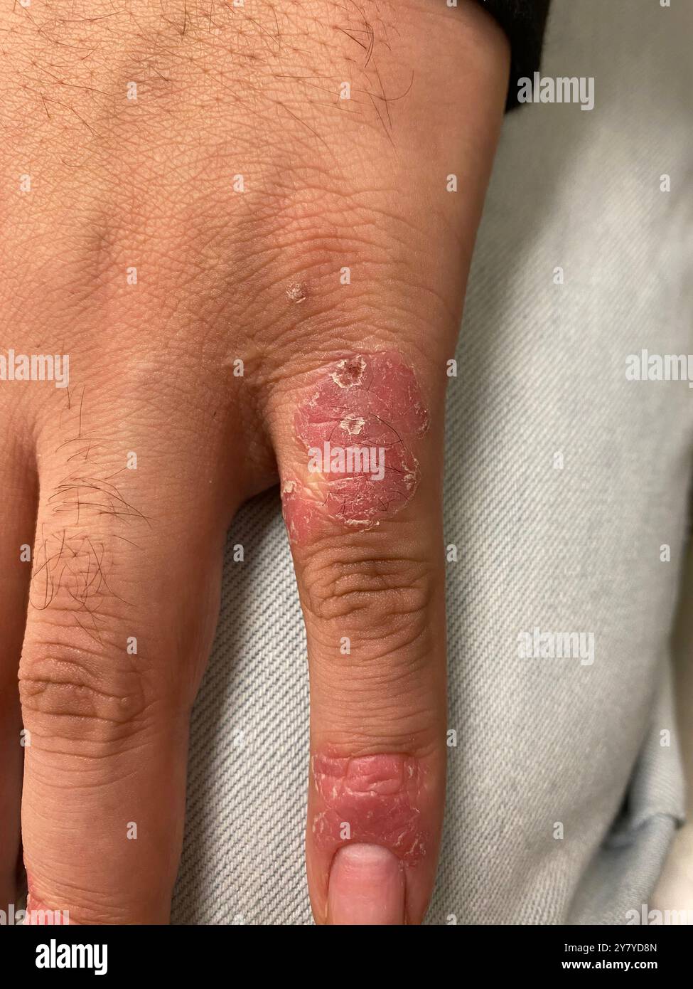 Psoriasis on the a patient's finger. Psoriasis is a skin condition where excessive growth of ...