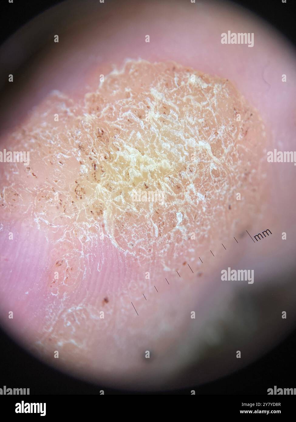 Dermatoscope image of a wart on the skin of a 12 year old Hispanic boy ...