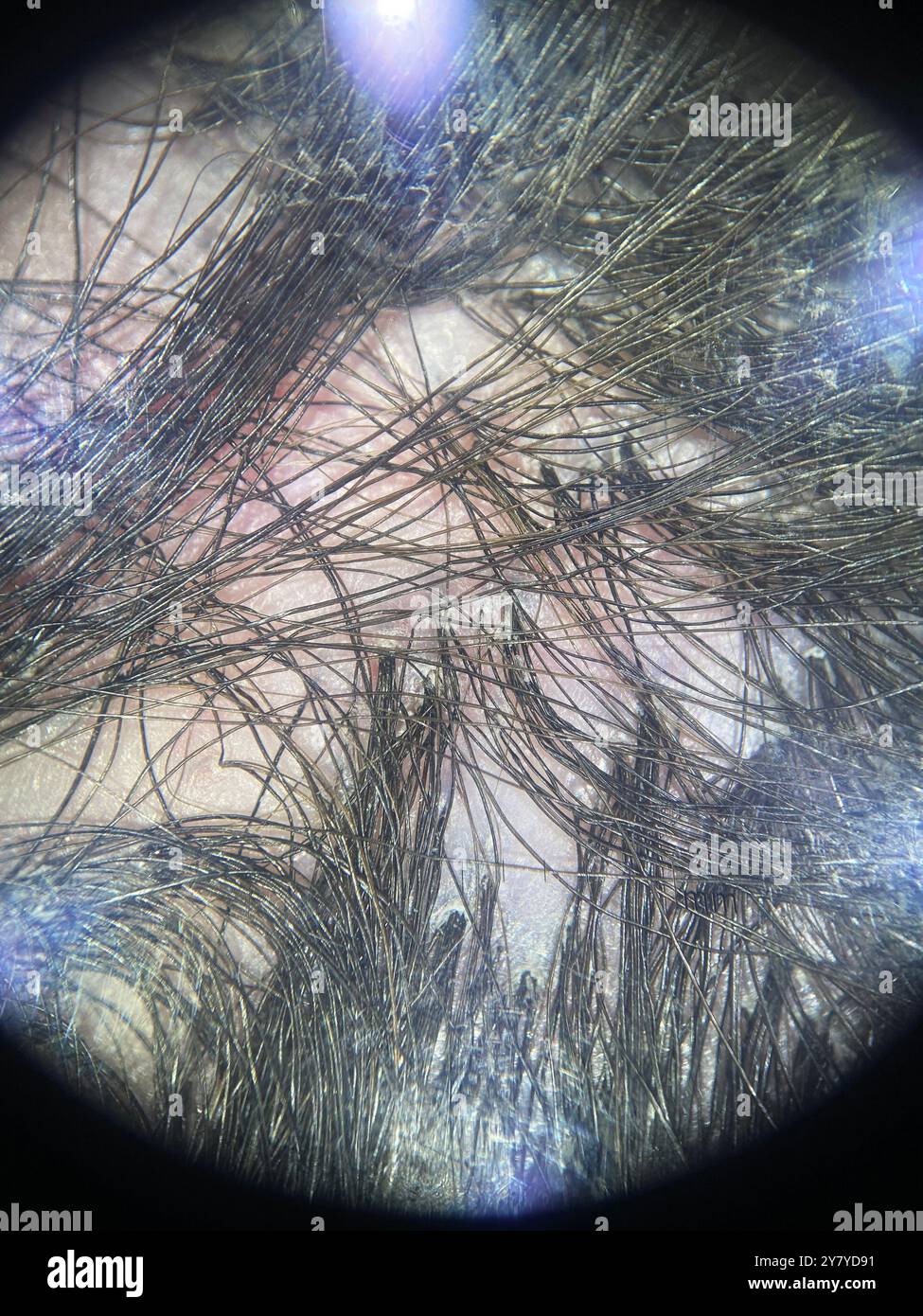 Trichoscope image of tufted folliculitis on the head of a Hispanic ...