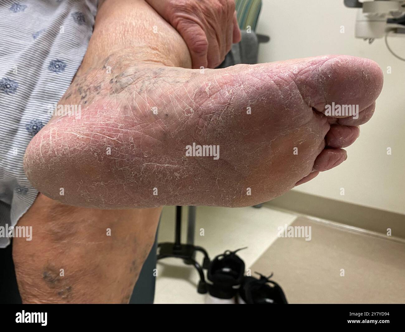 Athlete's foot infection. Athlete's foot, or tinea pedis, is a form of ...