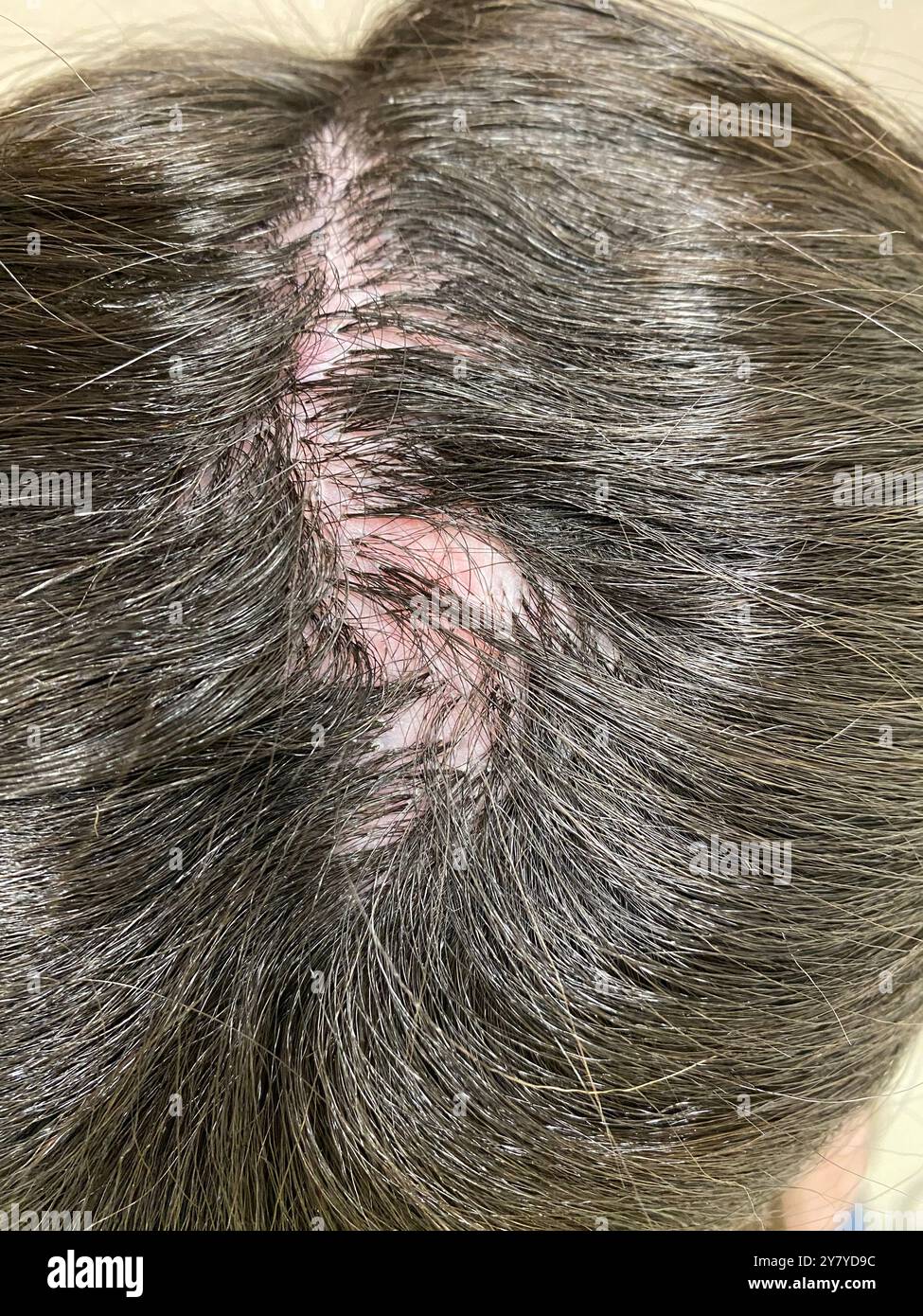 Tufted folliculitis on the head of a Hispanic female patient. In this ...