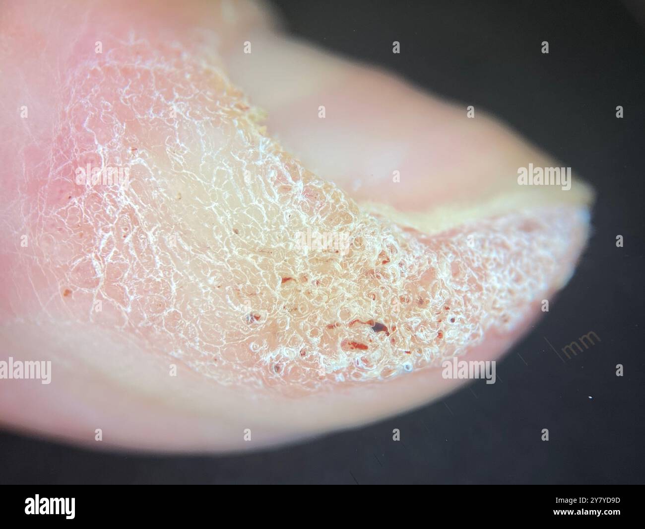 Dermatoscope image of warts around the thumb nail of a 12 year old ...