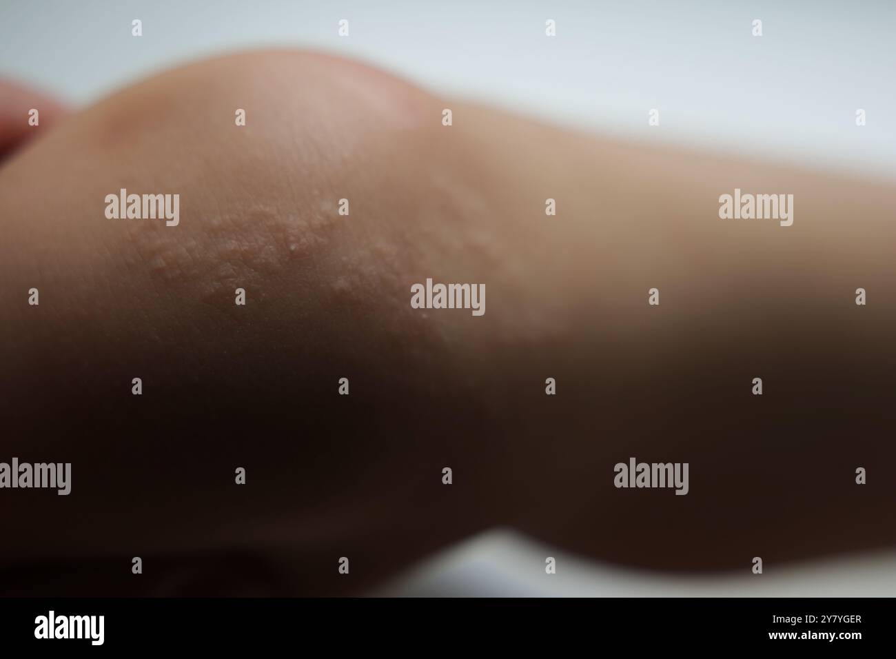 Atopic dermatitis red itchy hi-res stock photography and images - Alamy