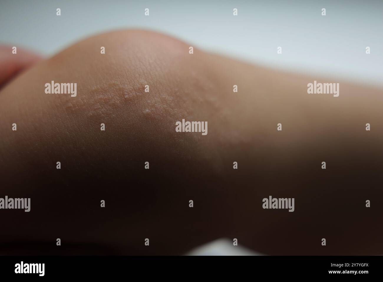 Body rash inflammation hi-res stock photography and images - Alamy