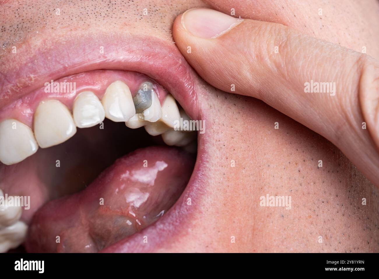 Caucasian male open mouth and teeth with broken upper premolar tooth ...