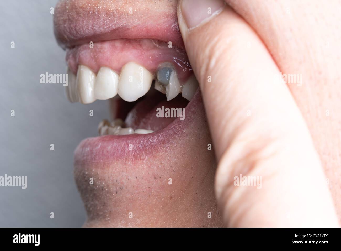 Open fracture hi-res stock photography and images - Alamy