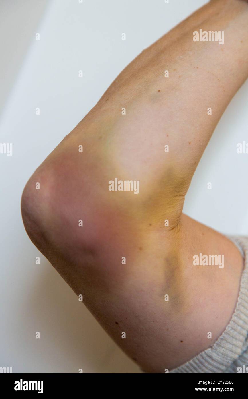 Woman's arm badly bruised from a fall Stock Photo - Alamy