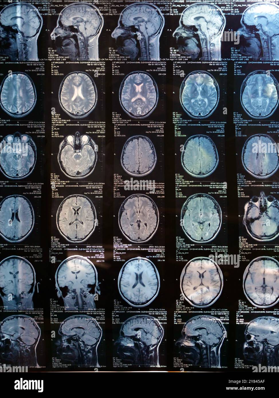MRI of the human brain of a patient with multiple sclerosis of the ...