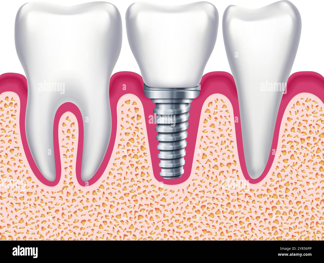 Dental prosthesis placement Stock Vector Images - Alamy