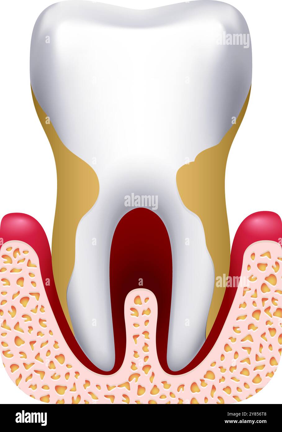 Periodontitis drawing. Dental clinic treatment. Tooth disease. Vector ...